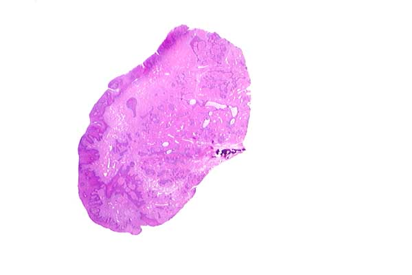 Peripheral giant cell granuloma and pyogenic granuloma giant cell ...