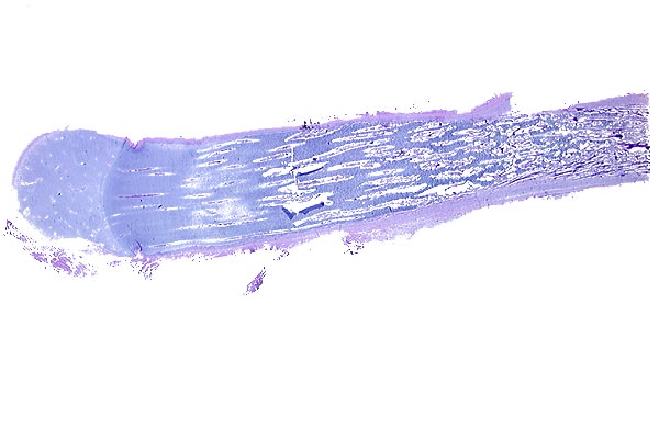 Osteomalacia Meaning Youtube