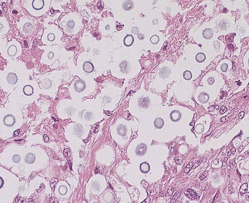 Cryptococcus Histology