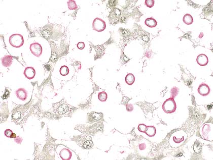 Cryptococcus Neoformans Mucicarmine Stain